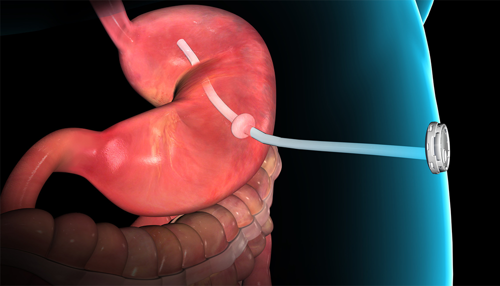 AspireAssist: A Low Risk Course to Weight Reduction - Marie On Diet