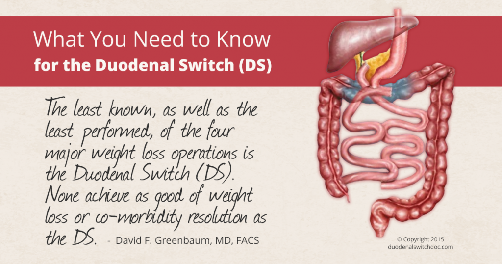 What You Need to Know for the Duodenal Switch (DS) : ObesityHelp