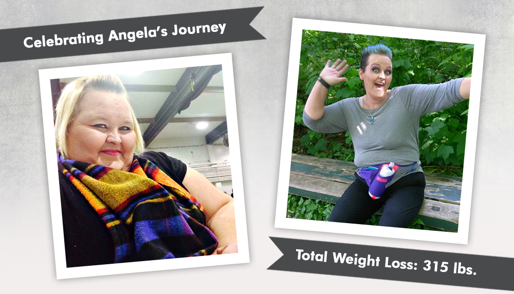 Before & After the Sleeve (VSG) with Angela, losing 315 pounds ...