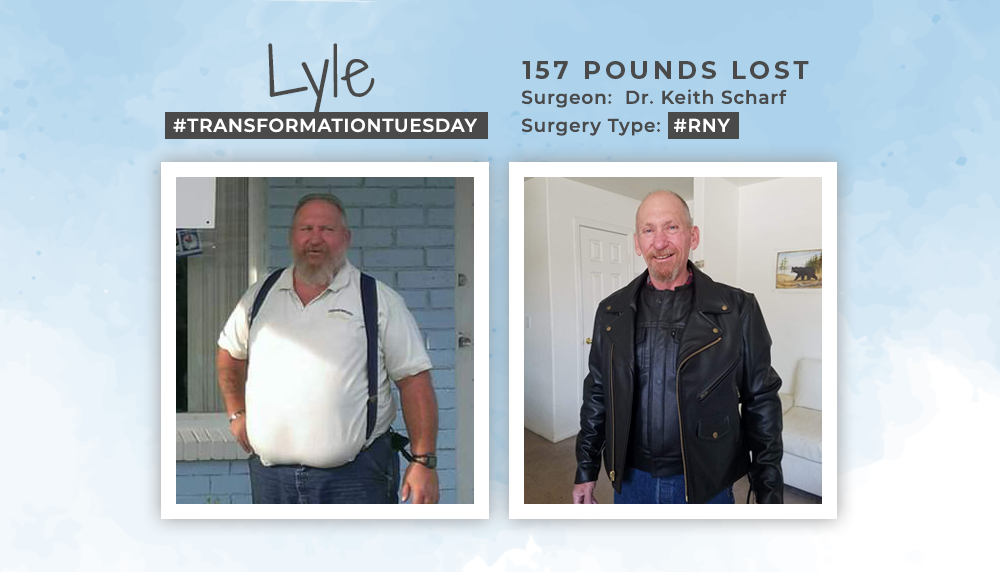 Before & After RNY with Lyle, losing 157 pounds! : ObesityHelp