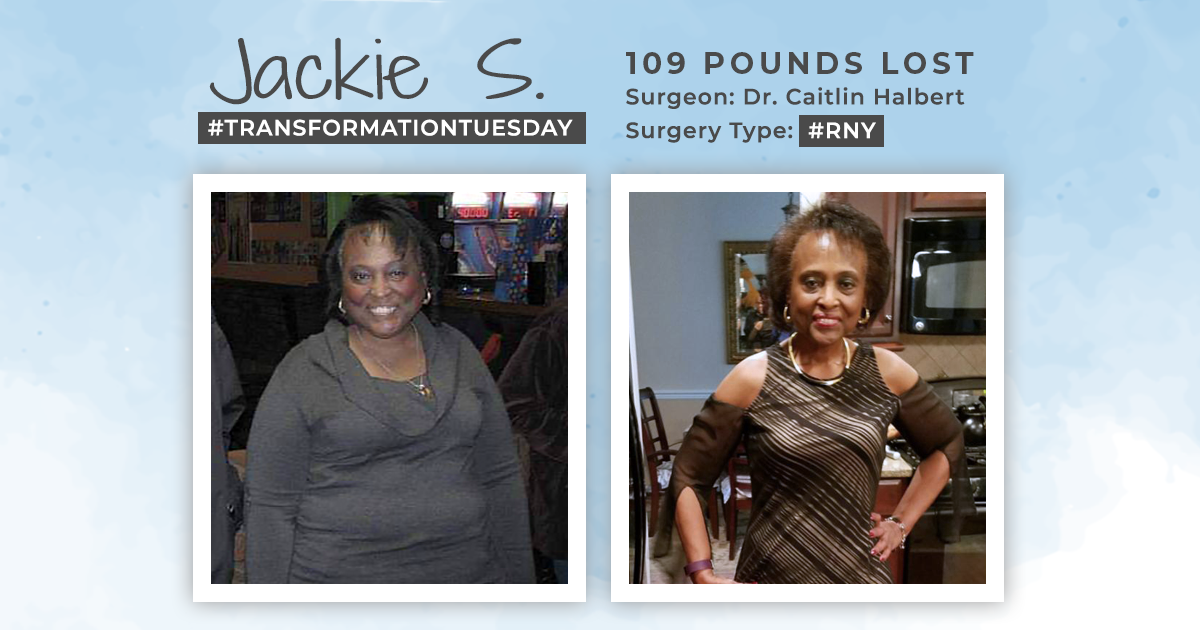 Before & After RNY with Jackie S., down 109 pounds! : ObesityHelp