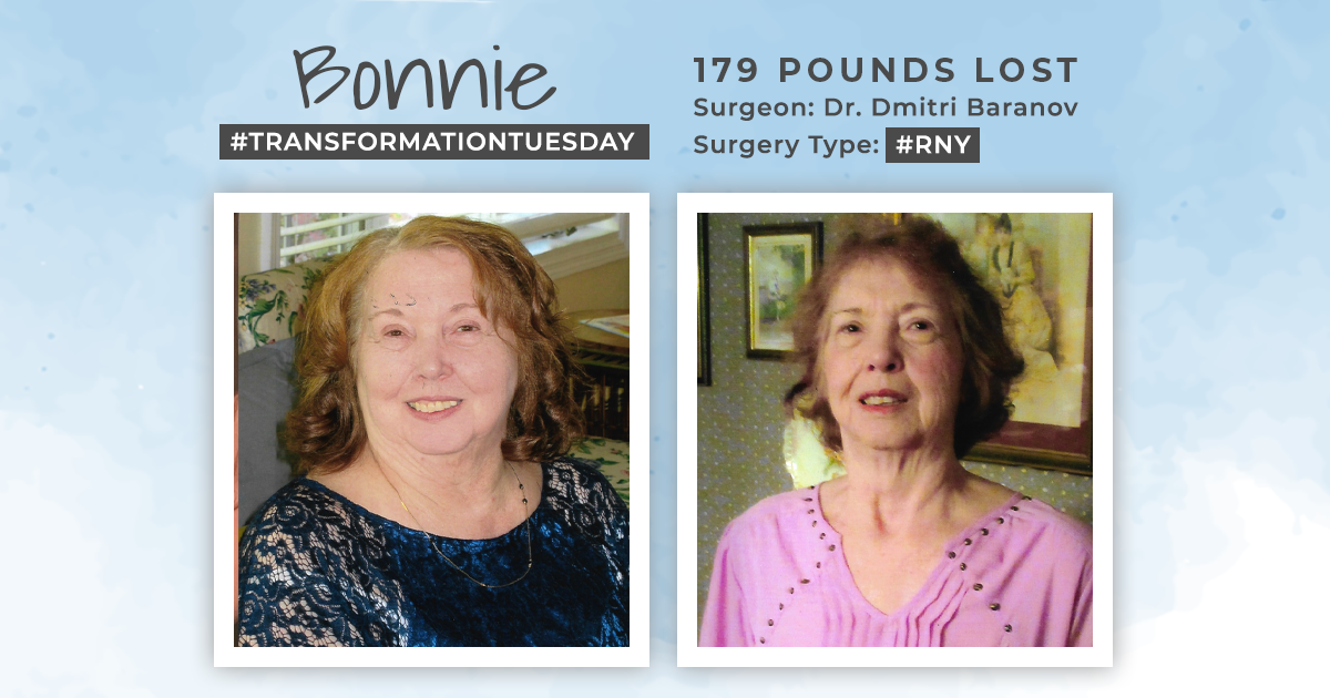 Before and After RNY with Bonnie, down 179 pounds! : ObesityHelp