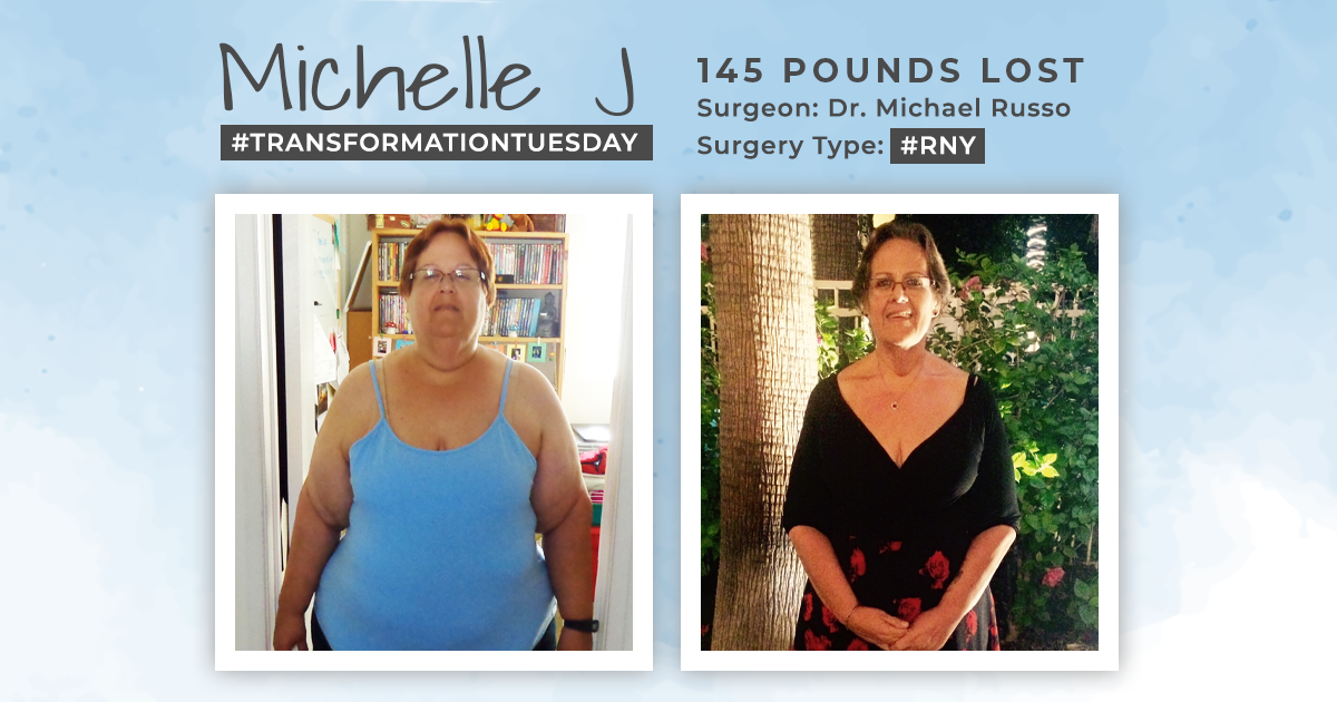 Before And After RNY With Michelle J Down 145 lbs! : ObesityHelp