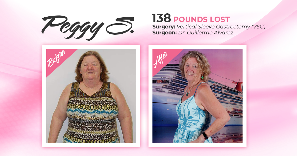 Before and After VSG With Peggy S. Down 138 Pounds! : ObesityHelp